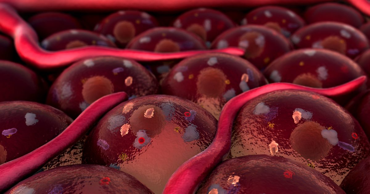 Frataxin Level Correlates With Friedreich's Ataxia Severity